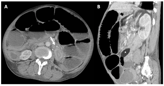 Closed-Loop Obstruction Caused by Double Intussusception in an Adult