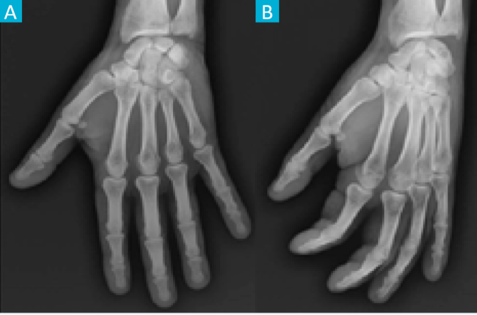 Rare Isolated Trapezium Fracture: Clinical Case Presentation