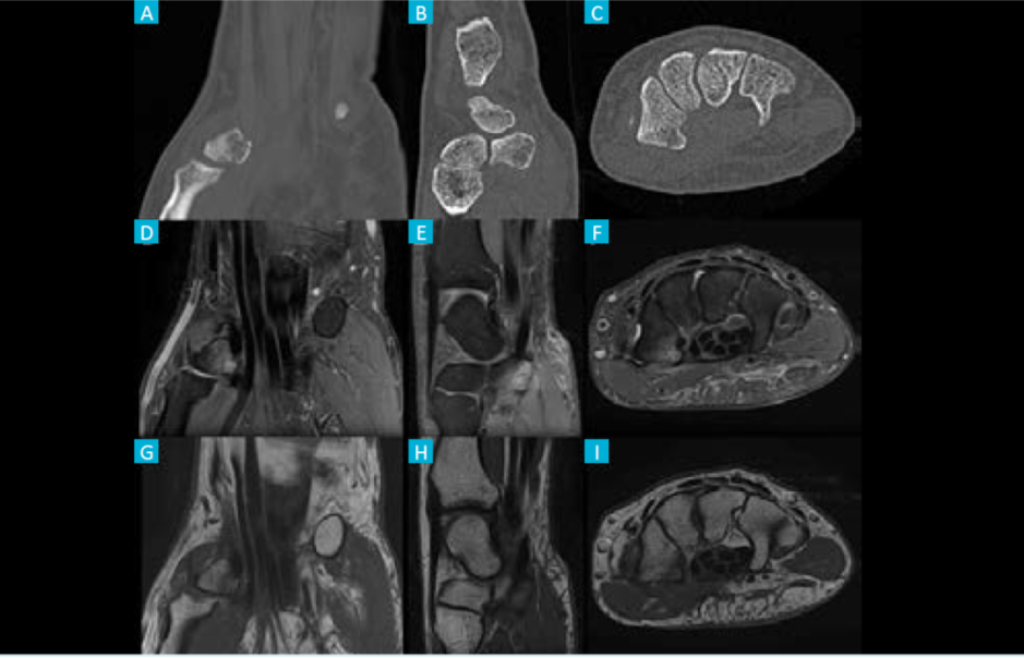 Rare Isolated Trapezium Fracture: Clinical Case Presentation