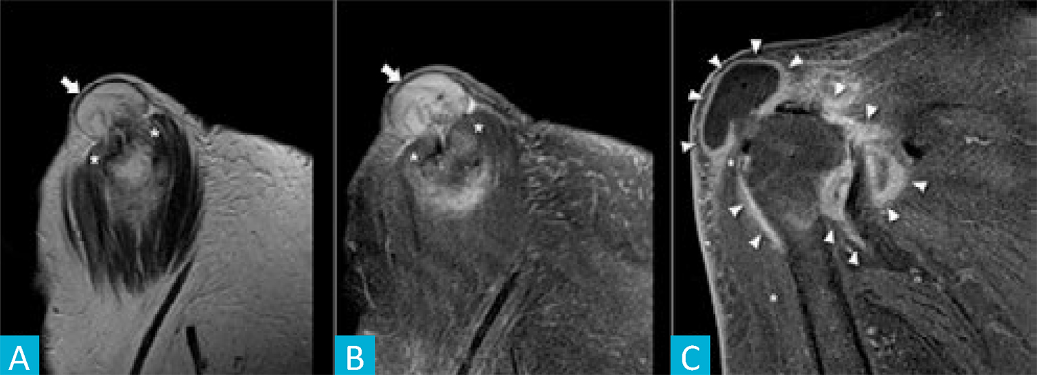 “Pseudo-Geyser Sign” as the First Presentation of Septic Arthritis of ...