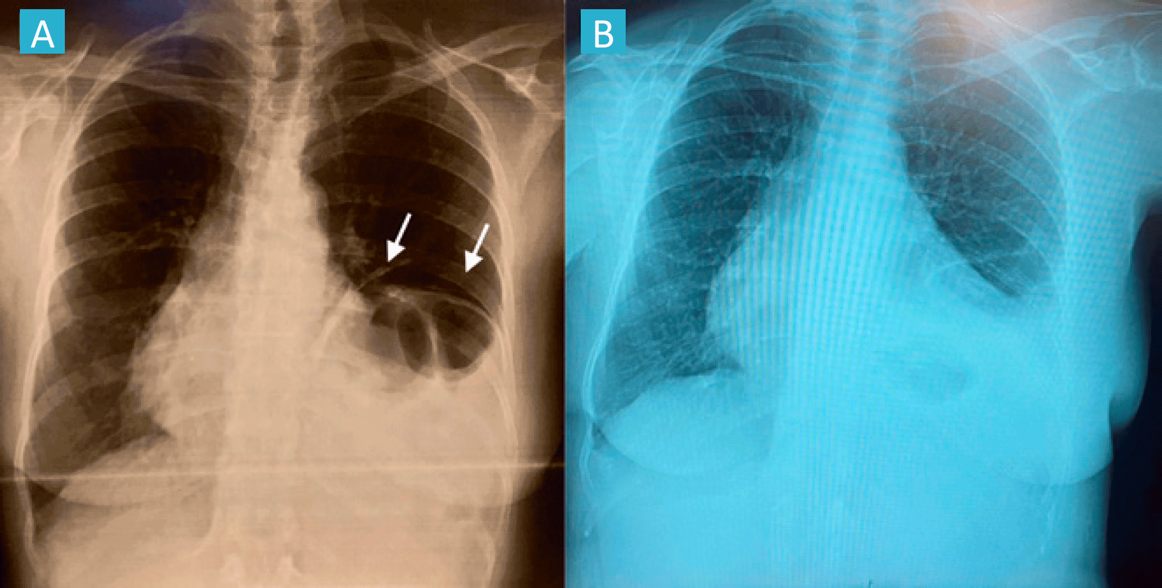 Diaphragmatic Eventration: A Late Complication of Perforating Cervical ...