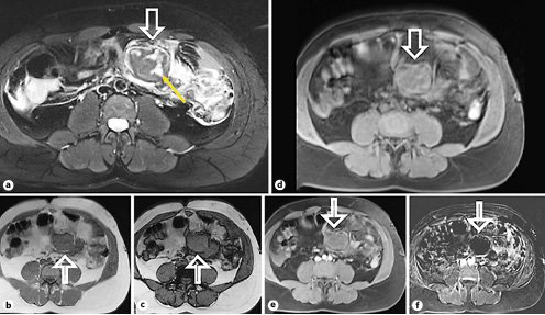 A Very Rare Case of Mass-Like Mesenteric Fat Necrosis in a Patient with ...