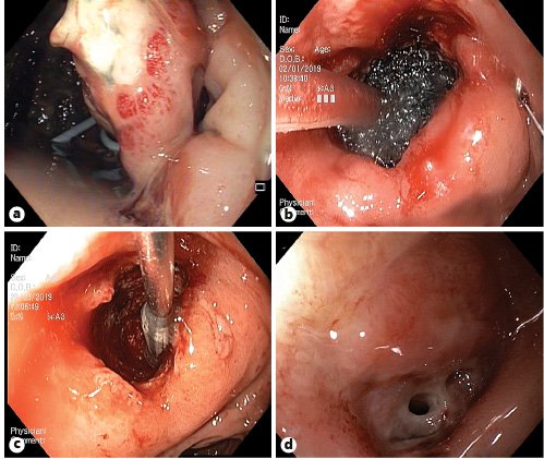 Management of Anastomotic Leak after Colorectal Surgery with Vacuum ...