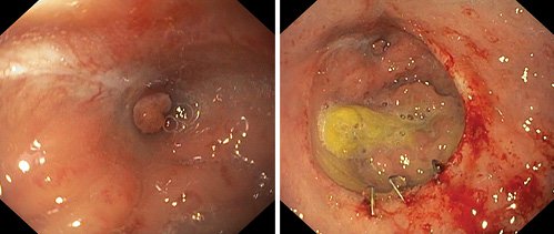 Management of Anastomotic Leak after Colorectal Surgery with Vacuum ...