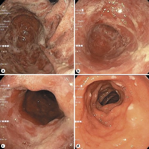 Checkpoint Inhibitor-Induced Gastroduodenitis: An Unusual Manifestation