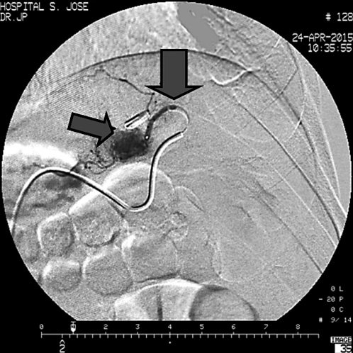 A Unique Case of Recurrent Upper Gastrointestinal Bleeding Caused by ...