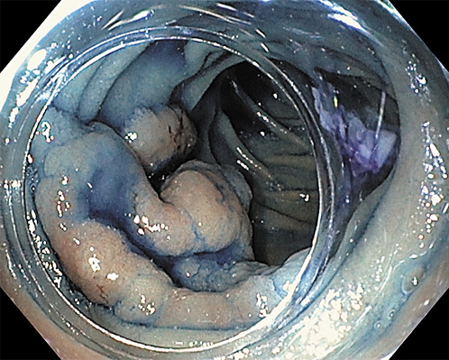 Underwater Duodenal ESD of a Large Adenoma Using the Pocket-Creation Method