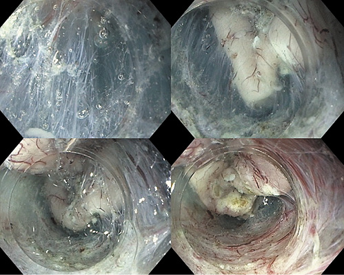 Underwater Duodenal ESD of a Large Adenoma Using the Pocket-Creation Method