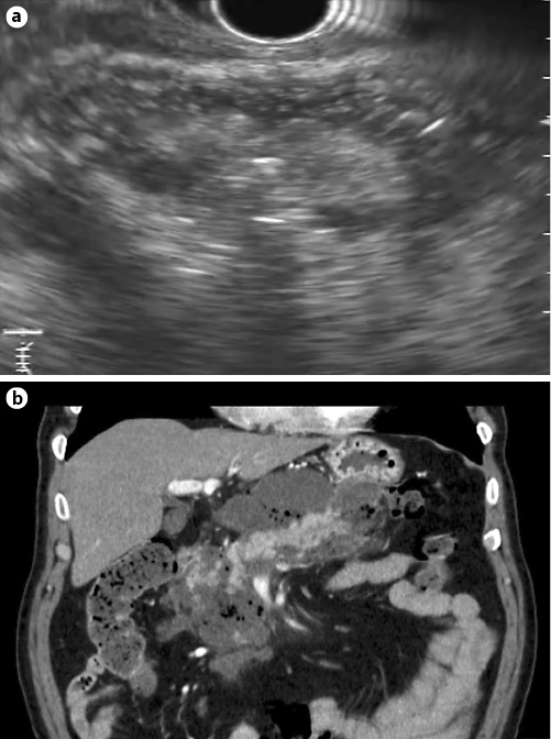 Infected Walled-Off Pancreatic Necrosis Treated with Multiple-Gateway ...