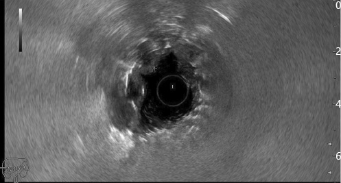 Pneumatosis Cystoides Intestinalis: A Rare Cause of Gastrointestinal ...
