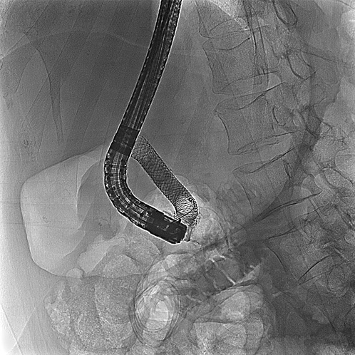 Palliative Biliary Drainage Using Endoscopic Ultrasound-Guided Rendezvous Procedure by ...