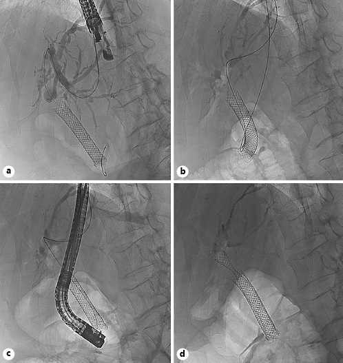 Palliative Biliary Drainage Using Endoscopic Ultrasound-Guided Rendezvous Procedure by ...
