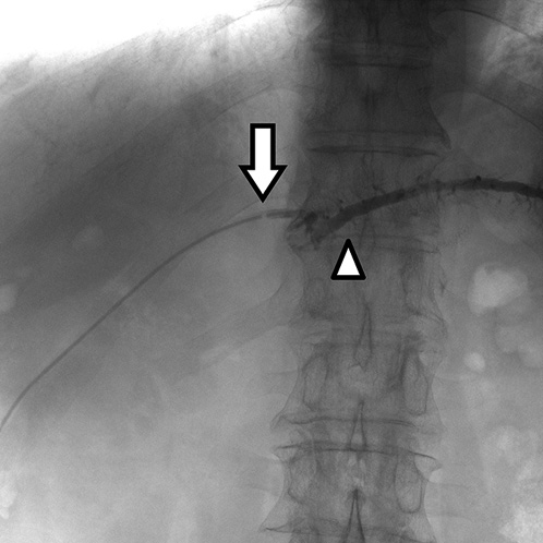 Endoscopic Restoration of a Dehiscent Pancreatojejunostomy after ...