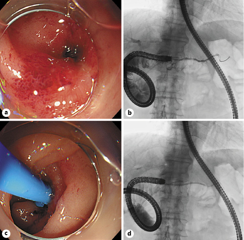 Endoscopic Restoration of a Dehiscent Pancreatojejunostomy after ...