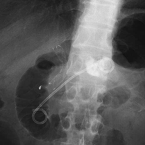 Pigtail Protruding out of the Gastric Wall