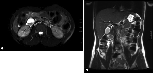 Endoscopic Management of Symptomatic Duodenal Duplication Cysts: Two ...