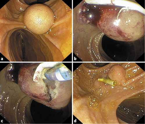Endoscopic Management of Symptomatic Duodenal Duplication Cysts: Two ...