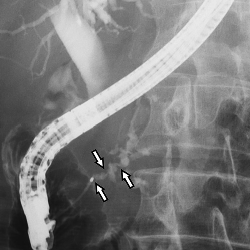 Successful Endoscopic Retrieval of a Retained Fractured Guidewire from ...