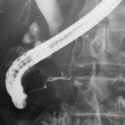 Successful Endoscopic Retrieval of a Retained Fractured Guidewire from ...