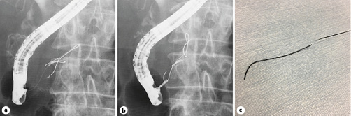 Successful Endoscopic Retrieval of a Retained Fractured Guidewire from ...