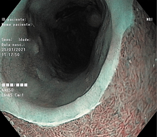 A Rare Cause of Food Impaction: Heterotopic Gastric Mucosa