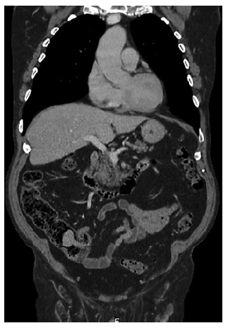 Solitary Peutz-Jeghers Type Hamartomatous Polyp Arising from the Appendix