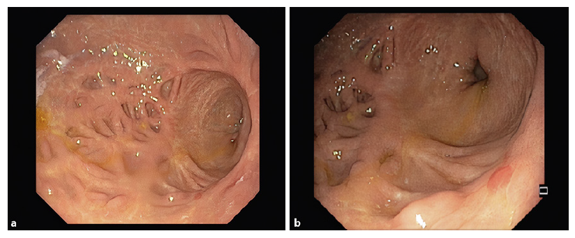 An Unusual Endoscopic Finding of Gastric Crohn’s Disease