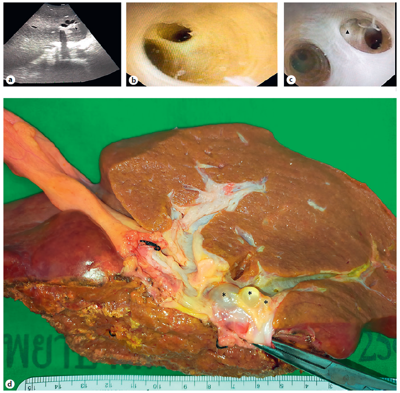 Peribiliary Cyst: An Unusual Mimicker of Cystic Liver Lesions