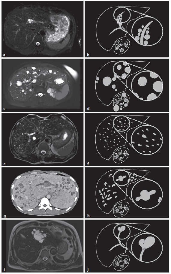 Peribiliary Cyst: An Unusual Mimicker of Cystic Liver Lesions