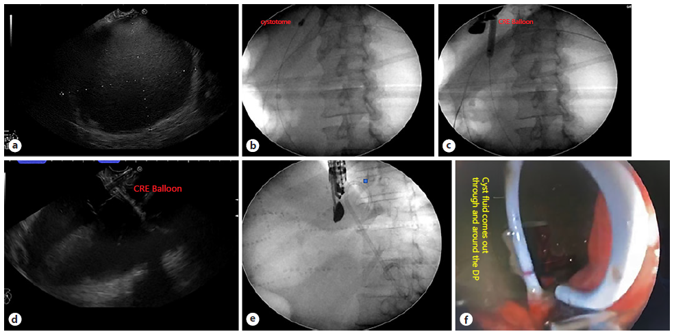 Technical and Clinical Outcomes of Using a Single Wide-Caliber Double ...