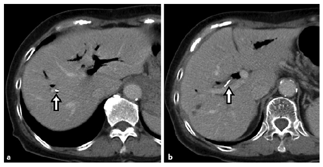 Bile Duct Ulcer due to a Migrated Pancreatic Stent after ...