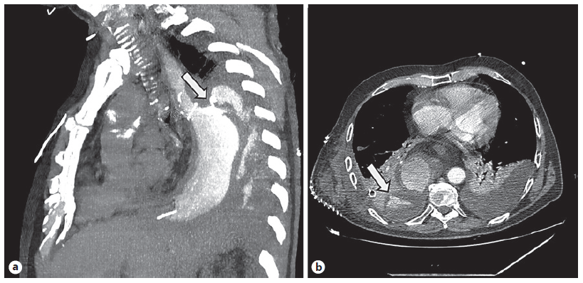 Niti-S Esophageal Mega-Stent: An Emerging Endoscopic Tool with ...