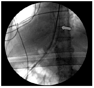 Niti-S Esophageal Mega-Stent: An Emerging Endoscopic Tool with ...