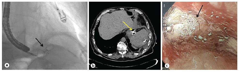 Endoscopic Management of a Chronic Gastrocutaneous Fistula after ...