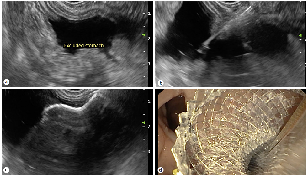 The Cutting-EDGE: Biliary Intervention in Altered Anatomy