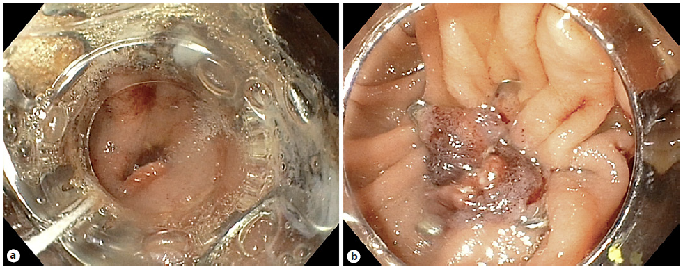 The Cutting-EDGE: Biliary Intervention in Altered Anatomy