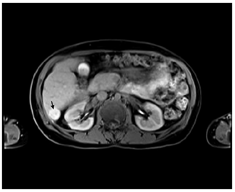 Multiple Liver Nodules in Fontan-Associated Liver Disease