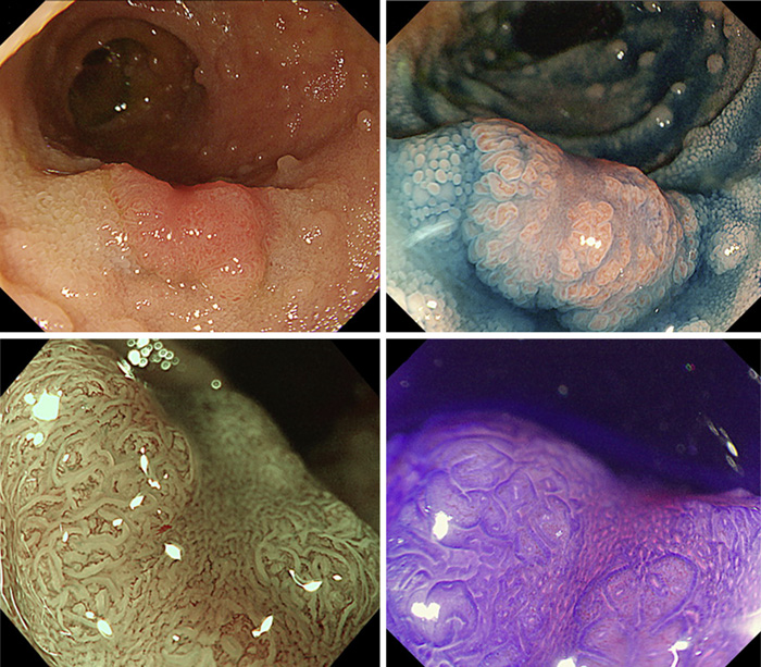 Underwater Endoscopic Mucosal Resection for a Terminal Ileum Adenoma