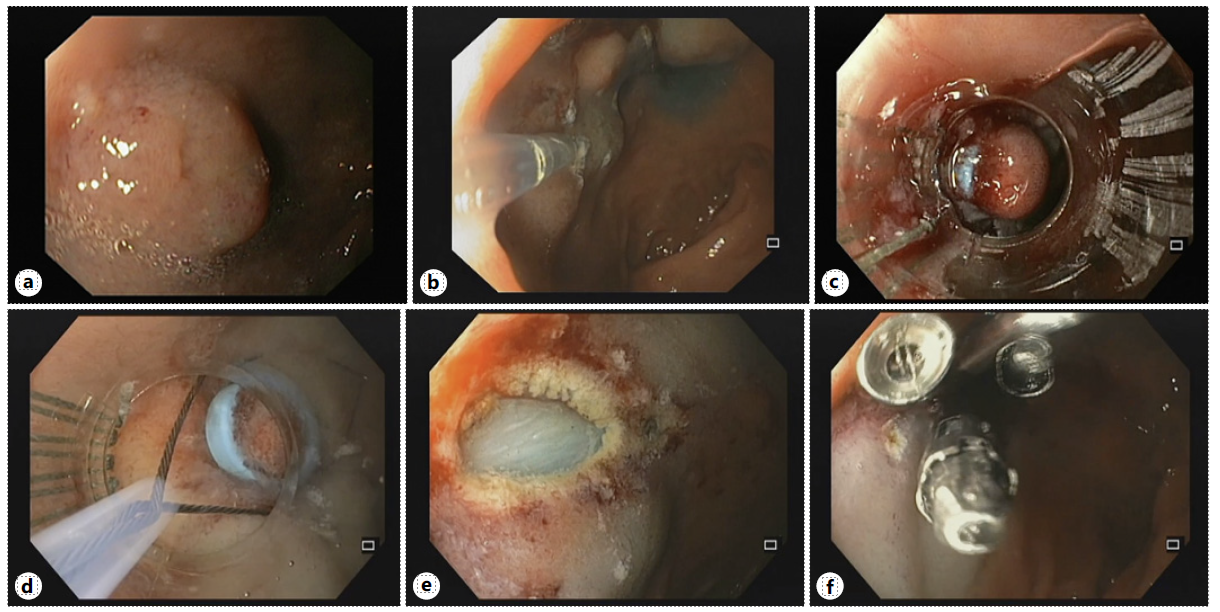 Endoscopic Mucosal Resection Using Band Ligation of a Duodenal ...