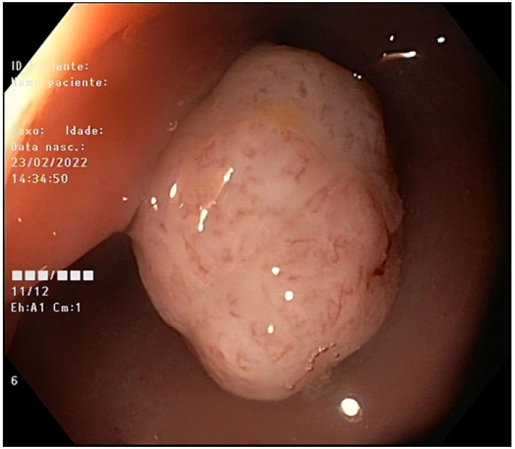 Granulation Polyp: A Pitfall for Digital Chromoendoscopy