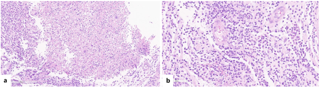 Granulation Polyp: A Pitfall for Digital Chromoendoscopy