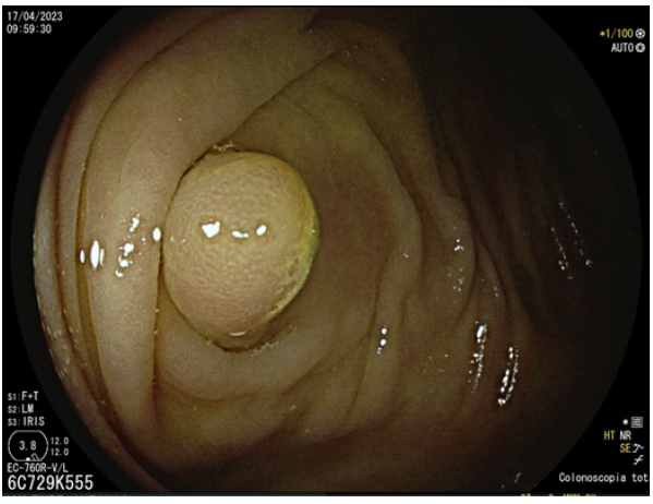 Appendiceal Submucosal Tumor: The Potential of Endoscopic Full ...