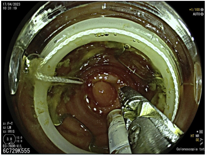 Appendiceal Submucosal Tumor: The Potential of Endoscopic Full ...