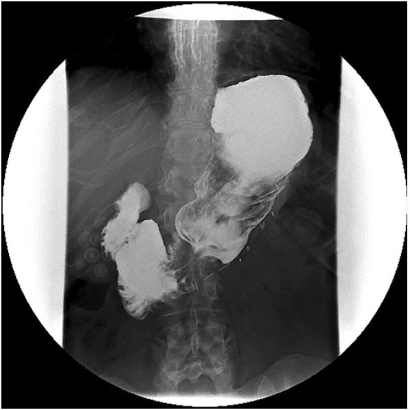 Endoscopic Management of Dysfunctioning Gastric Band after Sleeve ...