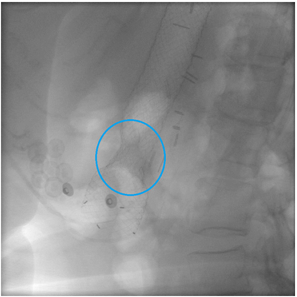 Endoscopic Management of Dysfunctioning Gastric Band after Sleeve ...