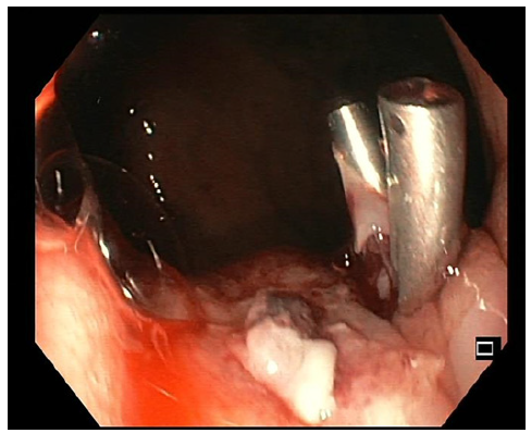 Gastric Mixed Neuroendocrine-Non-Neuroendocrine Neoplasm: An Unusual ...