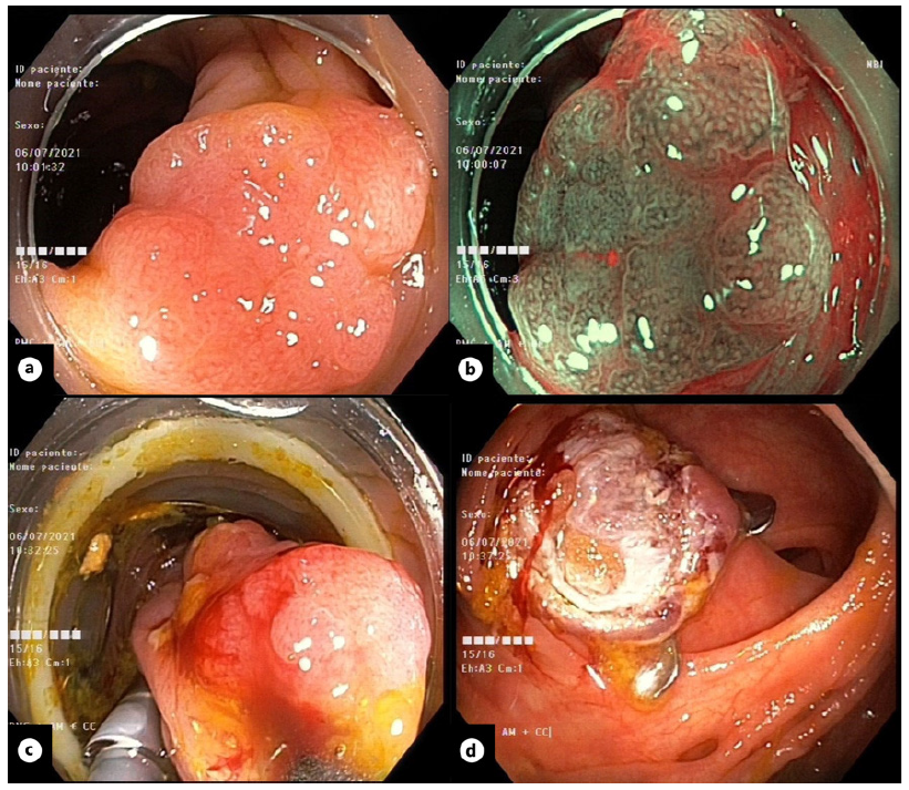 Colorectal Endoscopic Full-Thickness Resection: A Portuguese ...