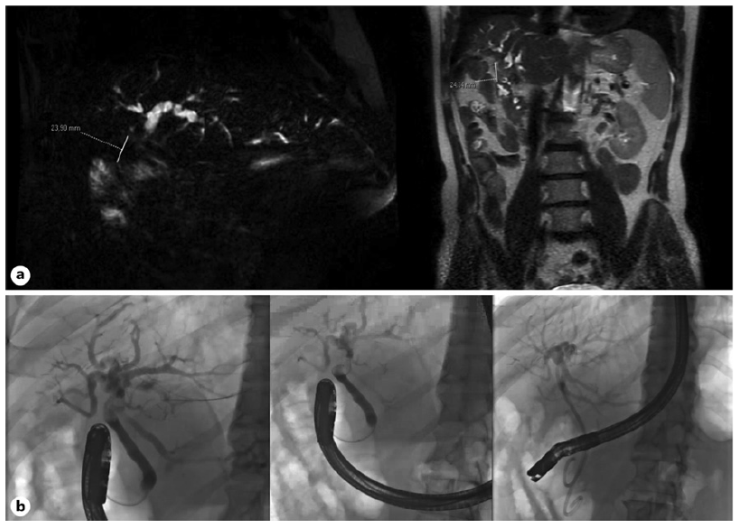 A Challenging Case of Recurrent Cholangitis Caused by Isolated Bile ...