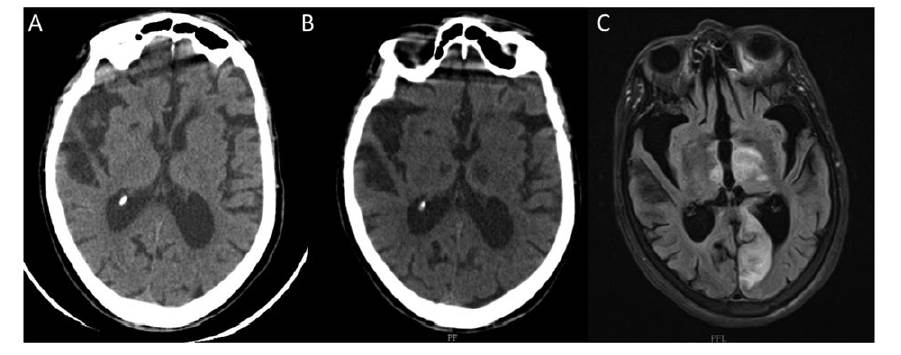 Artery of Percheron Infarction: Case Report