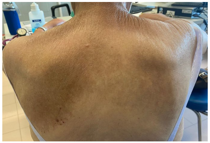 Dermatomiosite: A Importância do Olho Clínico